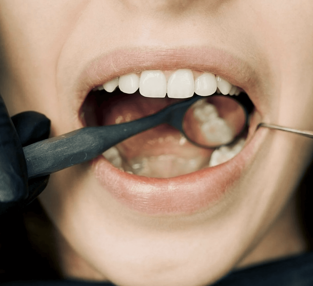 Understanding Tooth Fillings (Pasta) : Everything You Need to Know ...