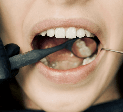 Understanding Tooth Fillings (Pasta) : Everything You Need to Know ...
